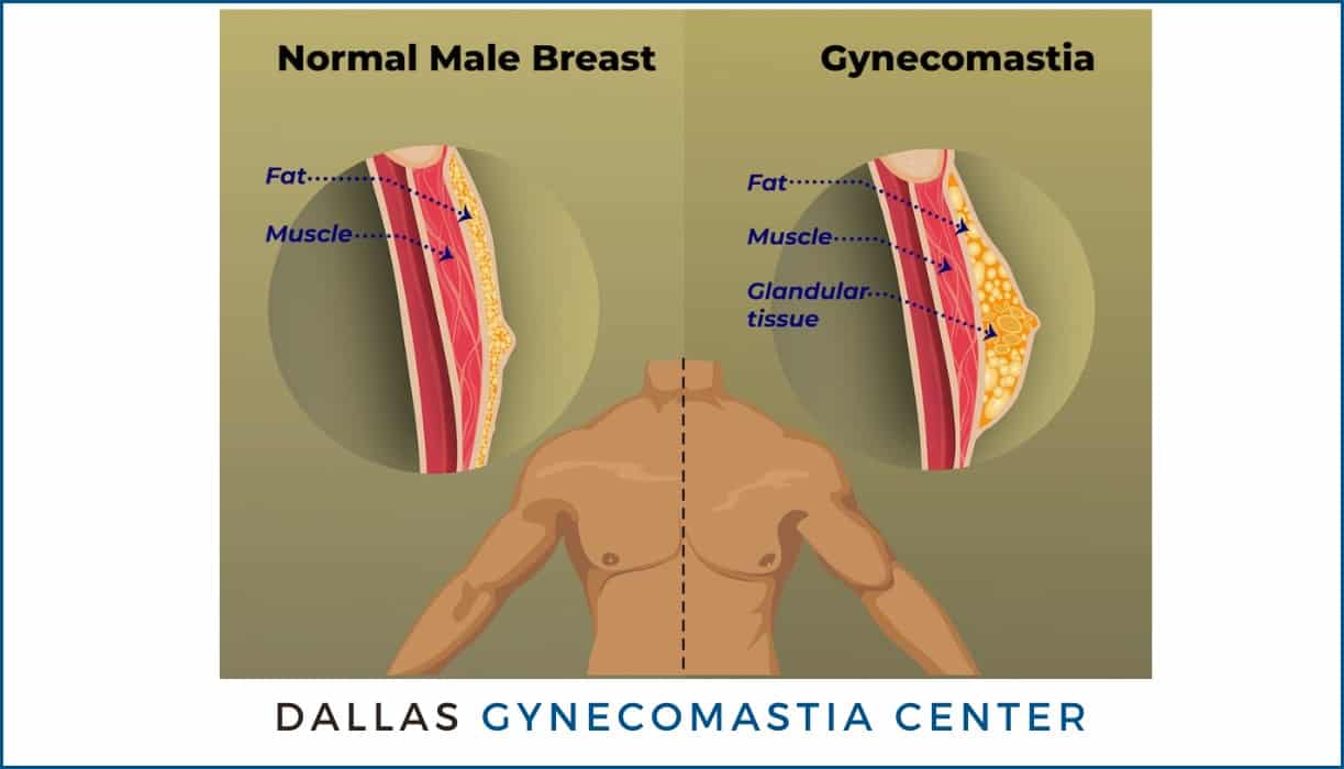 Adult Gynecomastia Surgery (Dallas Gyno Plastic Surgeons)
